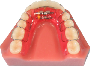 Invisalign | Lexington Park Dentistry